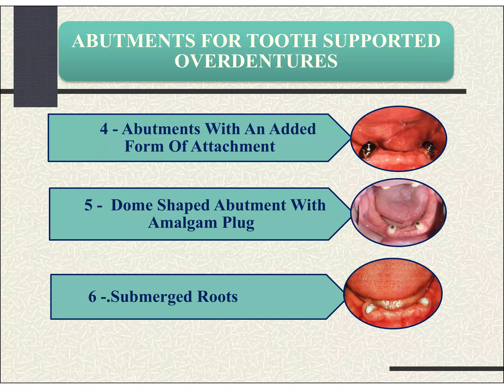 Over denture | PDF