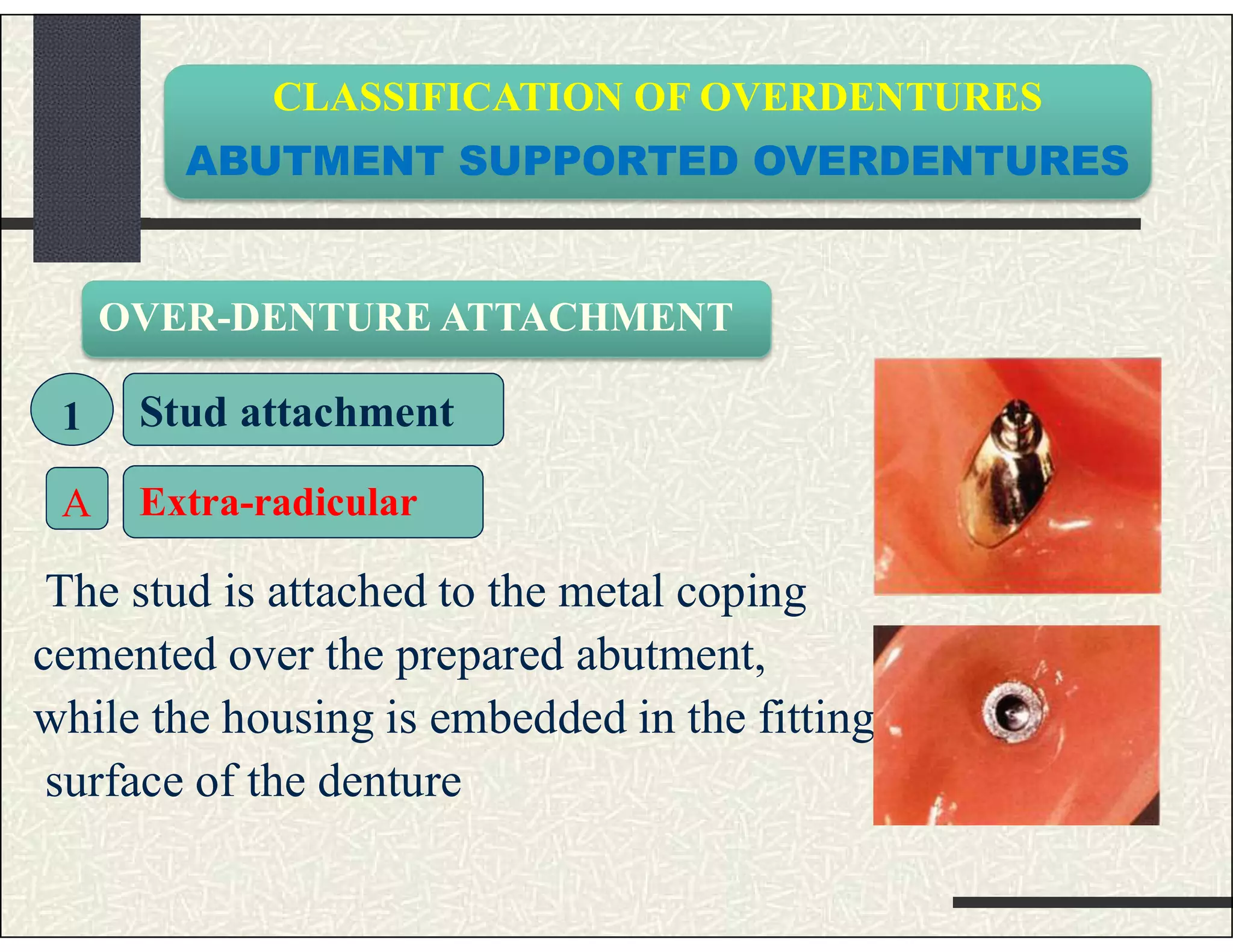 Over denture | PDF