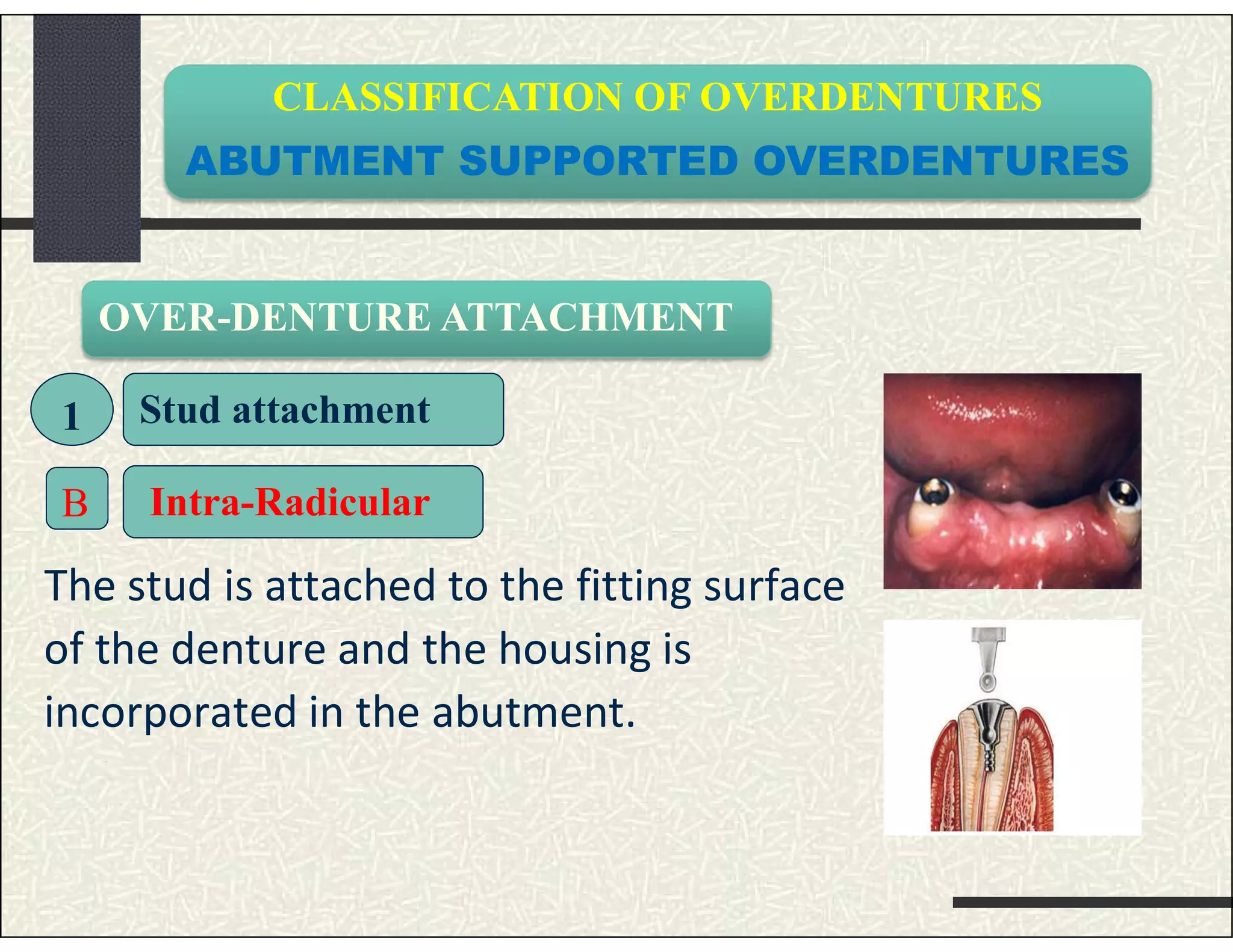 Over denture | PDF