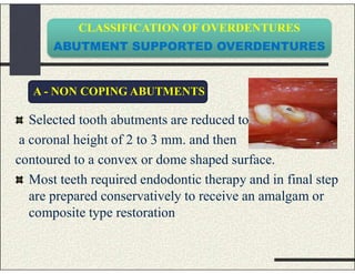 Over denture | PDF