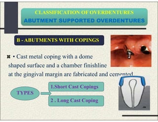 Over denture | PDF