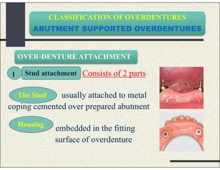 Over denture | PDF