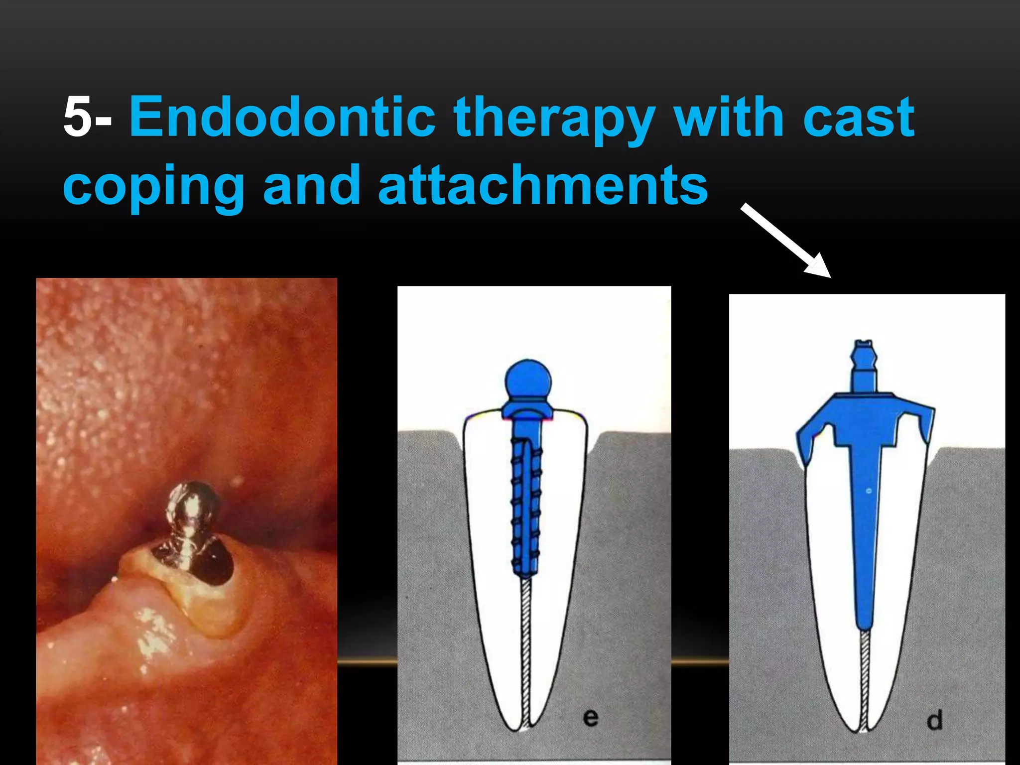 Over denture(s) | PPTX