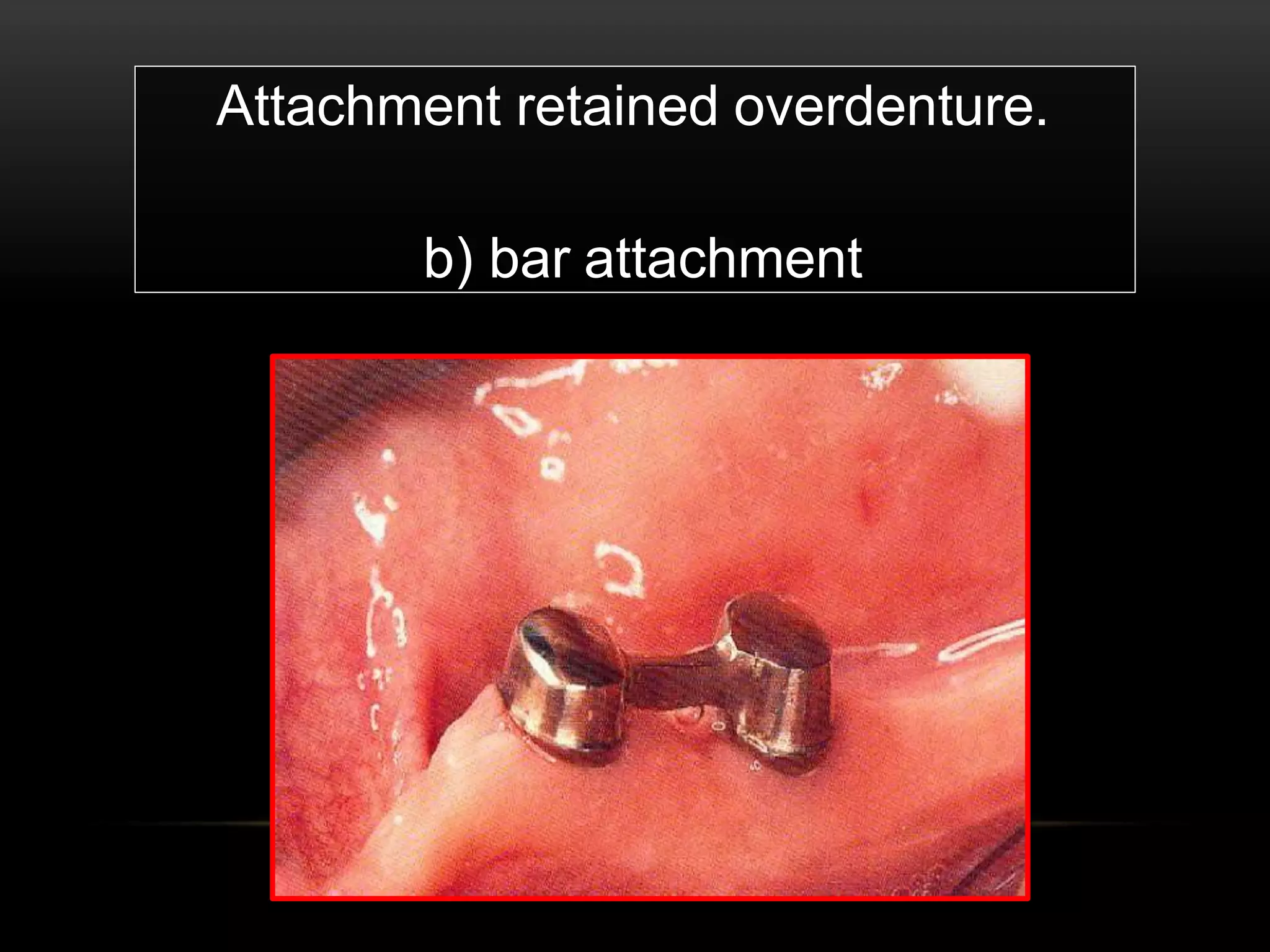Over denture(s) | PPTX