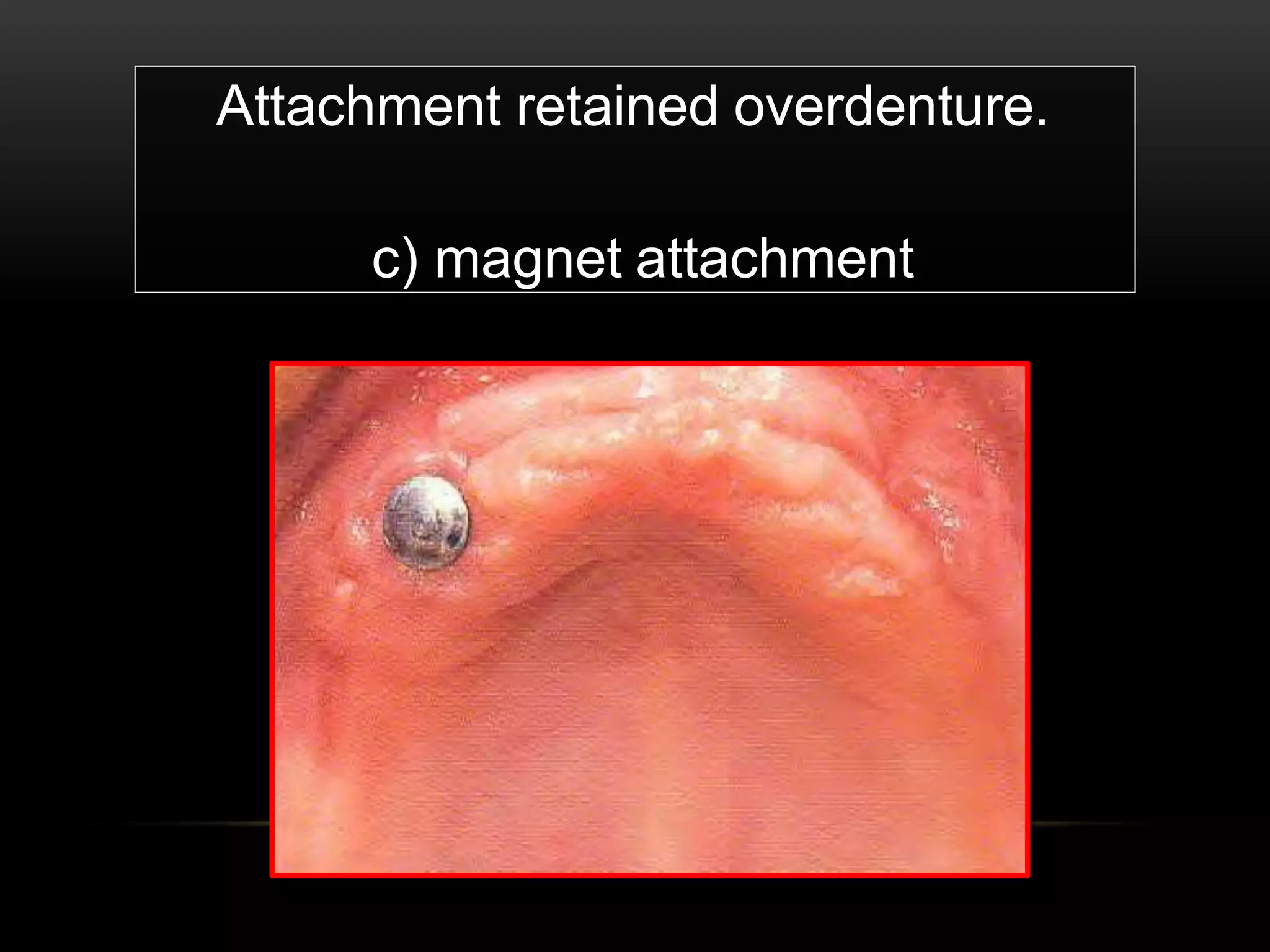 Over denture(s) | PPTX