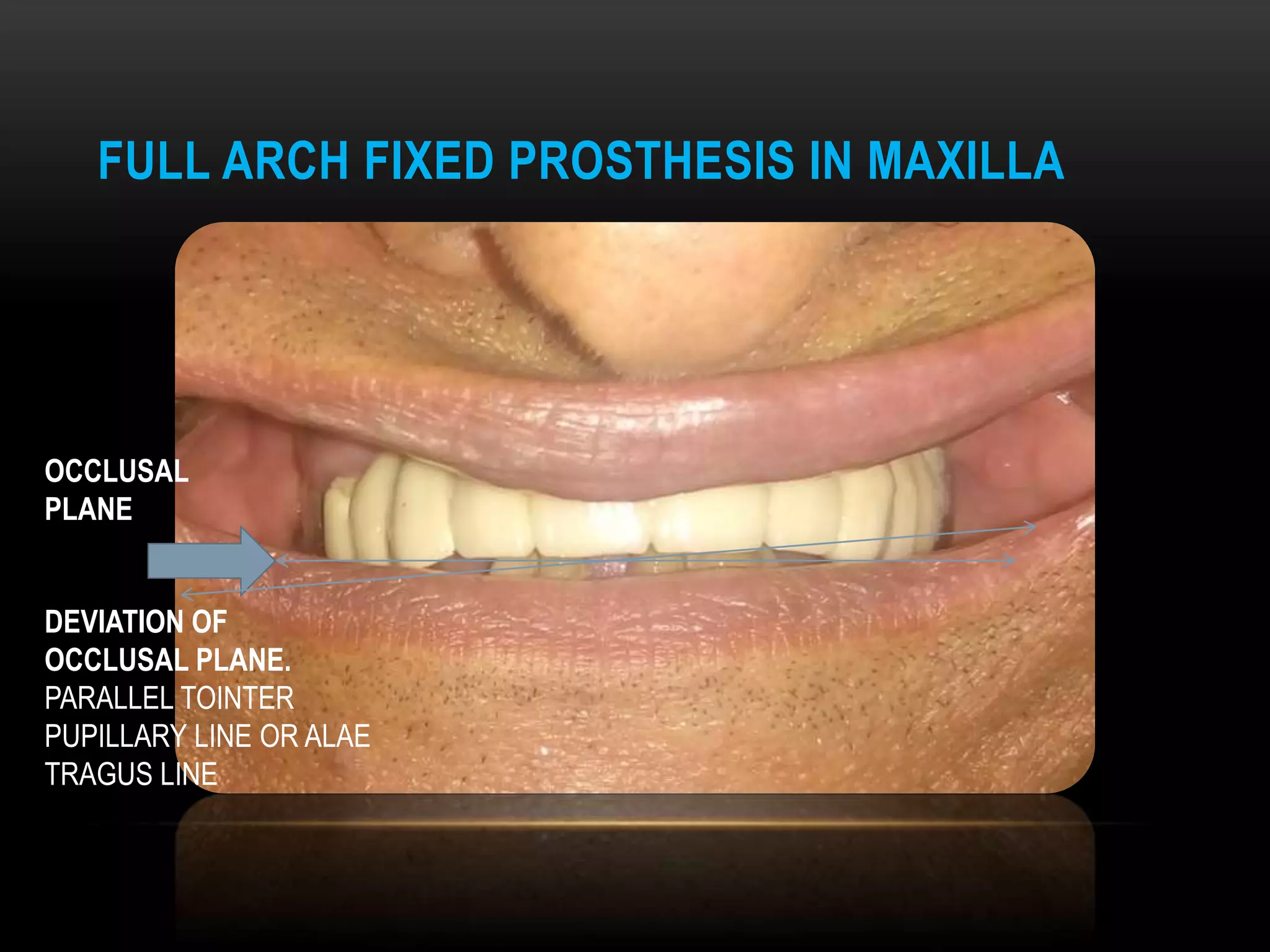 Over denture(s) | PPTX