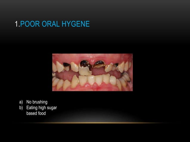 Over denture(s) | PPTX