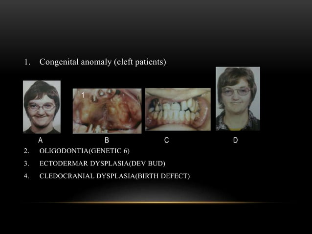 Over denture(s) | PPTX