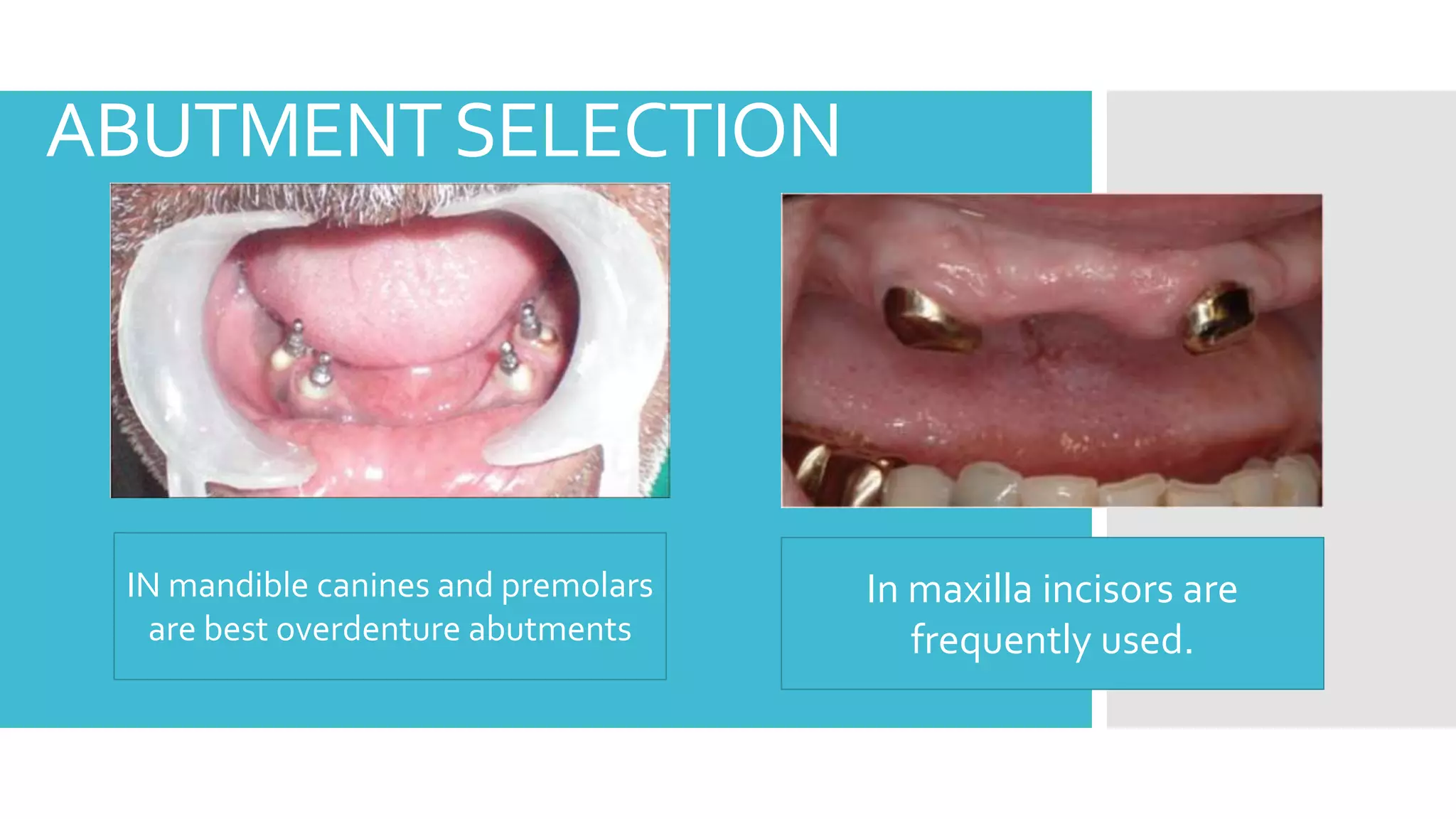 TOOTH SUPPORTED OVERDENTURES | PPTX