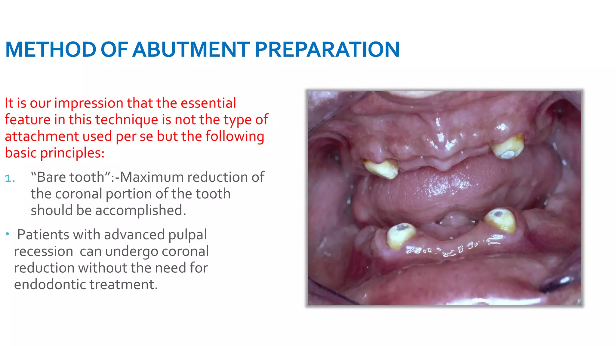 TOOTH SUPPORTED OVERDENTURES | PPTX
