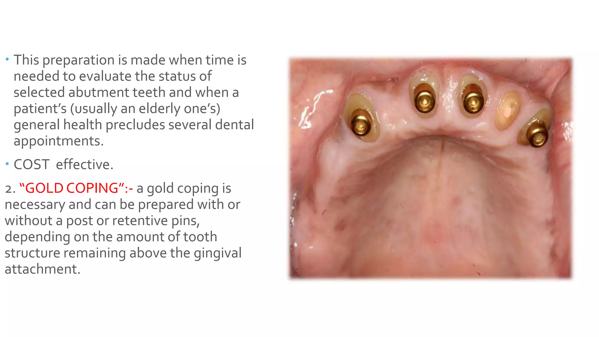 TOOTH SUPPORTED OVERDENTURES | PPTX