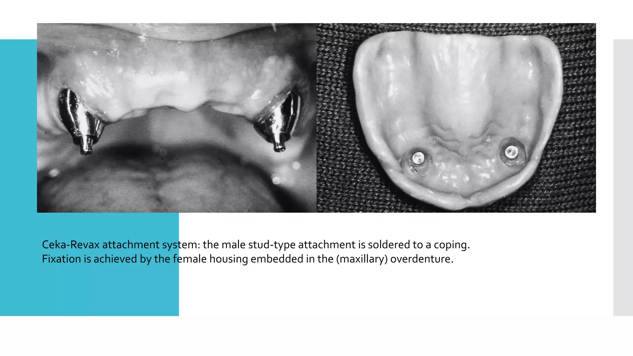 TOOTH SUPPORTED OVERDENTURES | PPTX