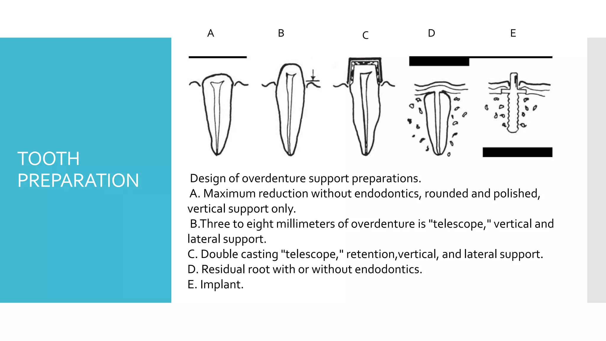 TOOTH SUPPORTED OVERDENTURES | PPTX