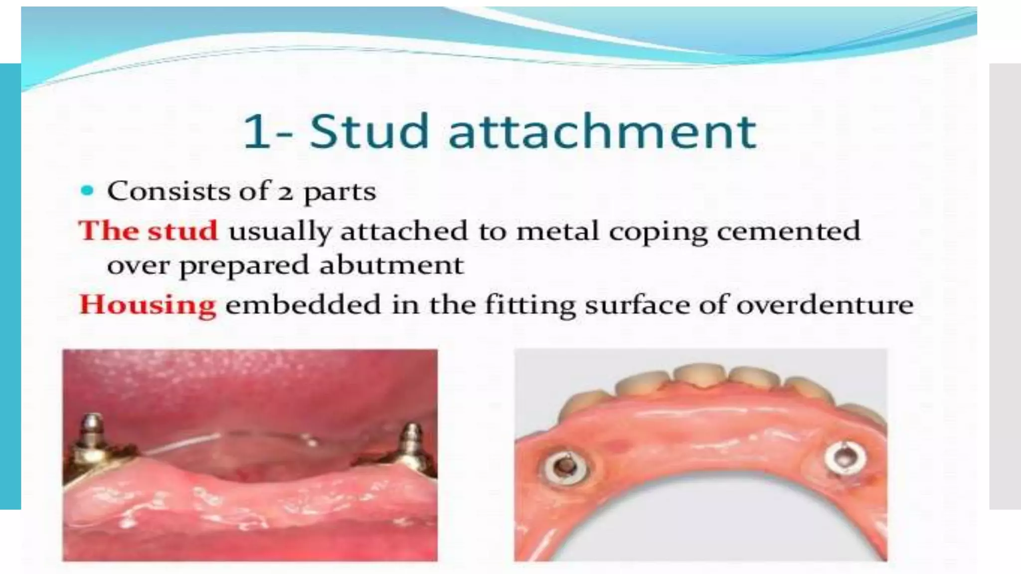 TOOTH SUPPORTED OVERDENTURES | PPTX