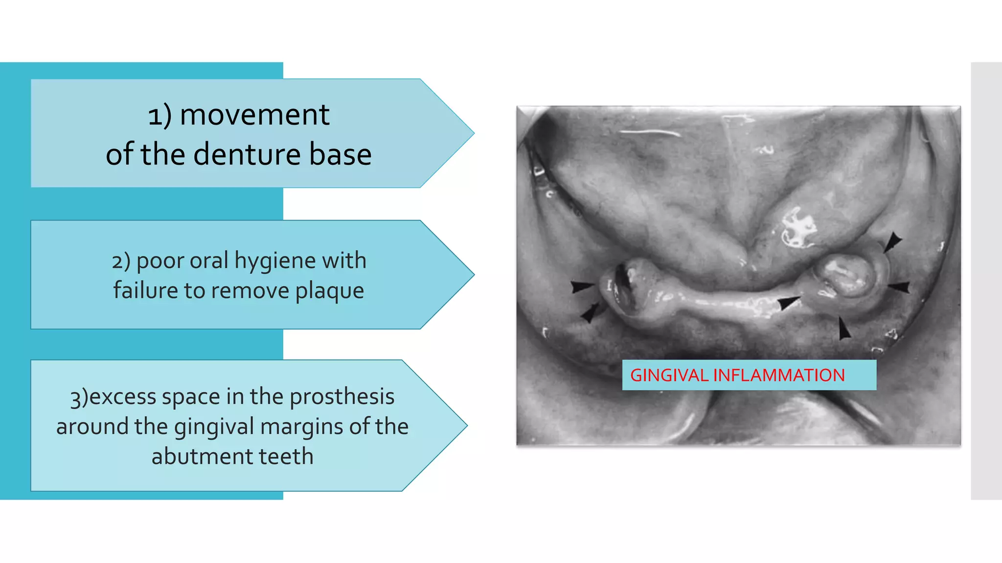 TOOTH SUPPORTED OVERDENTURES | PPTX