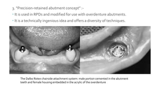 TOOTH SUPPORTED OVERDENTURES | PPTX