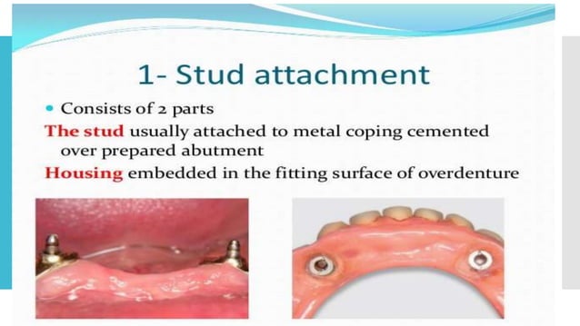 TOOTH SUPPORTED OVERDENTURES | PPTX | Dental Health | Diseases and ...