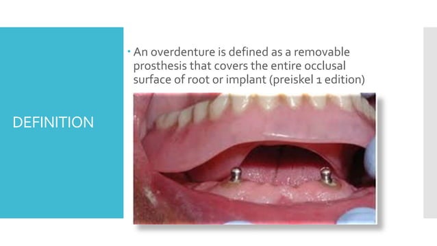 TOOTH SUPPORTED OVERDENTURES | PPTX | Dental Health | Diseases and ...