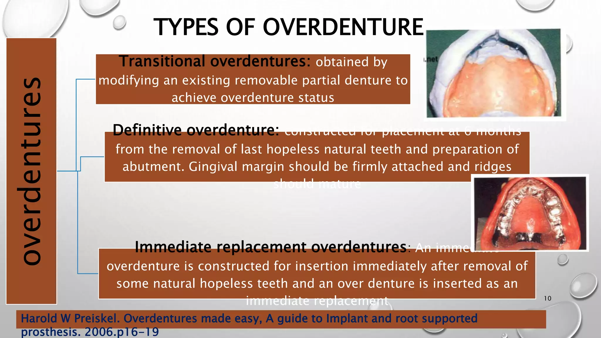 Overdentures | PPTX