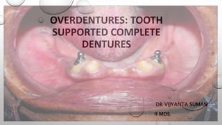 Overdentures | PPTX