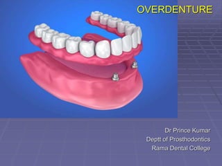 Overdentures - Indications, Contraindication and Treatment Procedure.ppt