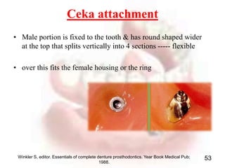 Over dentures and its attachment | PPTX