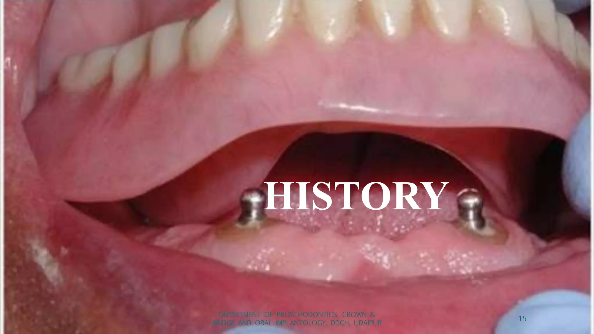 tooth supported Overdentures | PPTX