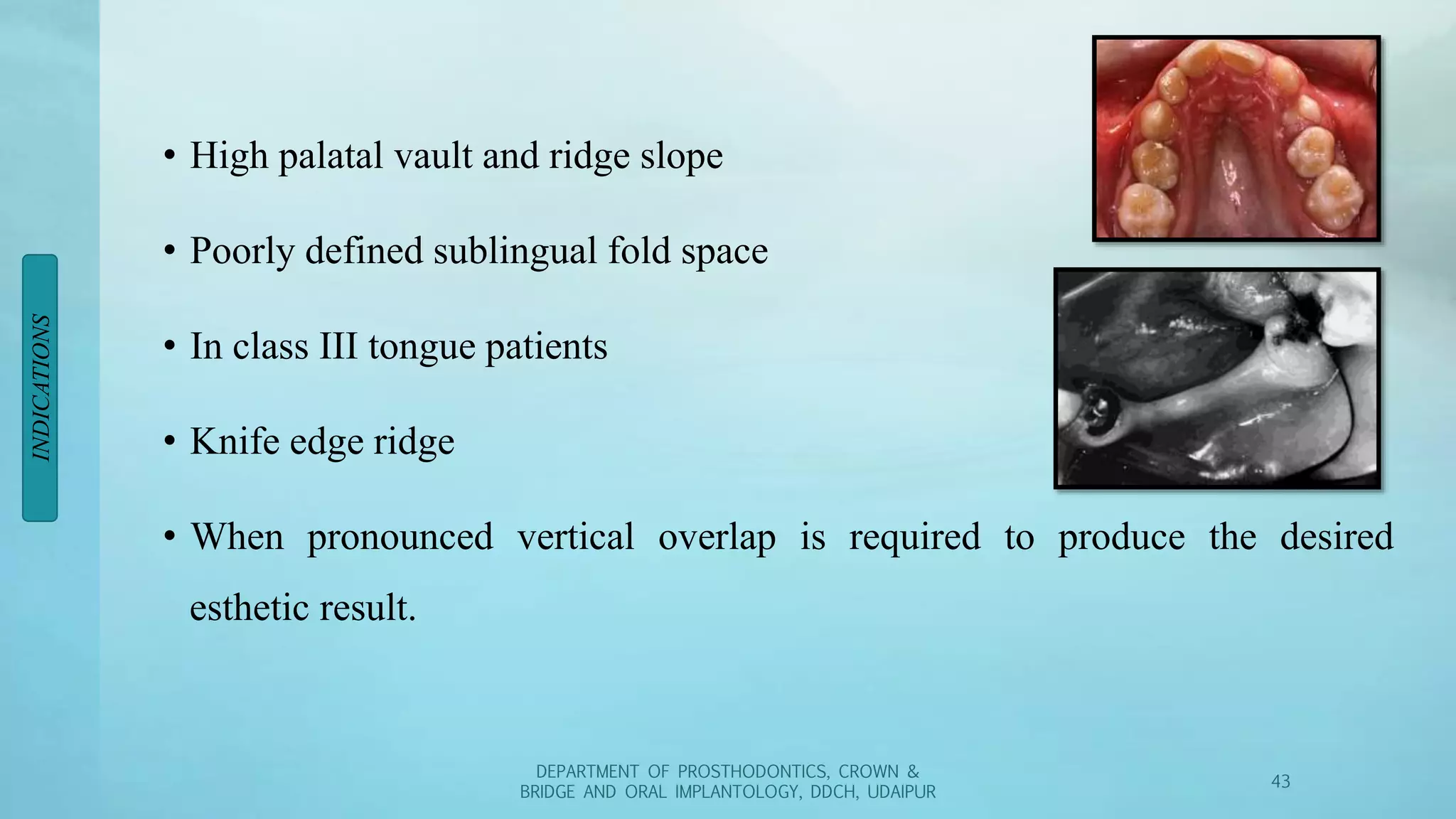 tooth supported Overdentures | PPTX