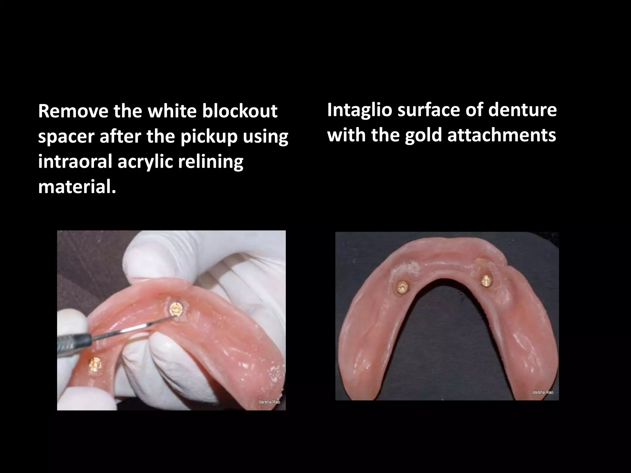 Mandibular overdenture with friadent ball and socket attachment | PPTX