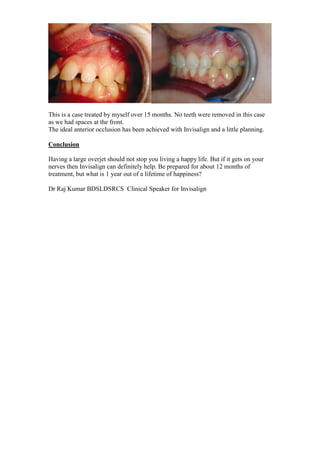 Overjet/Overbite | PDF