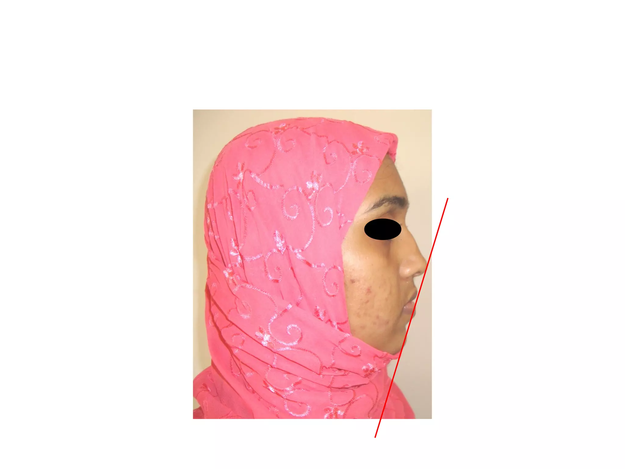 Overjet reduction(2) | PPT