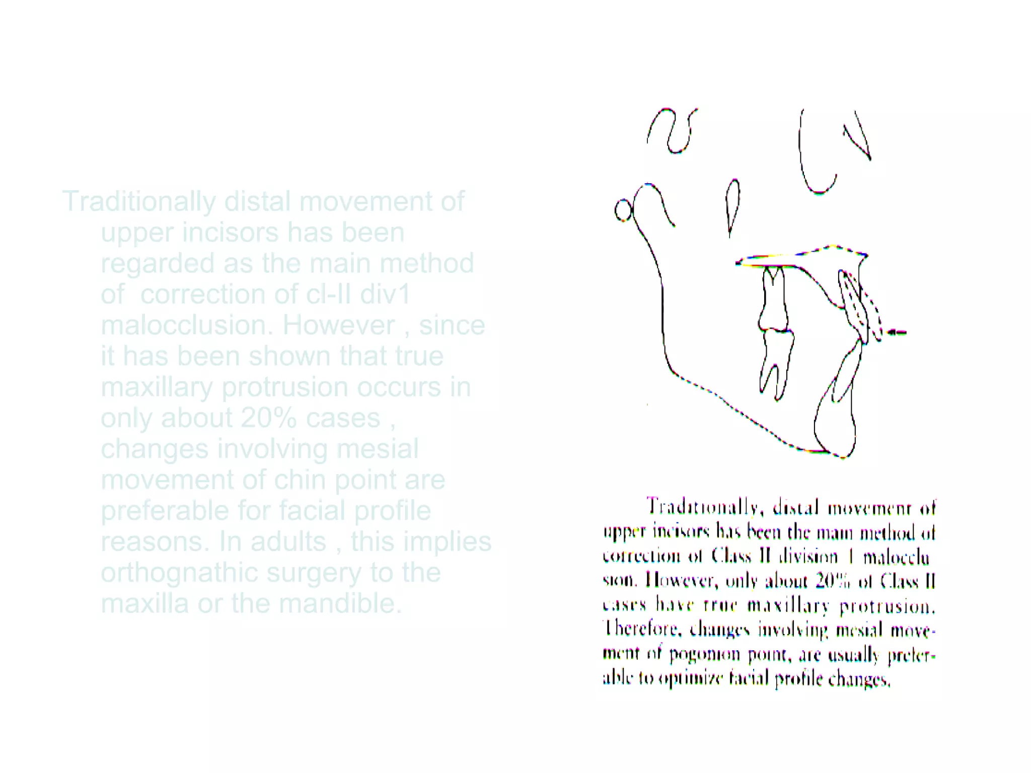 Overjet reduction(2) | PPT