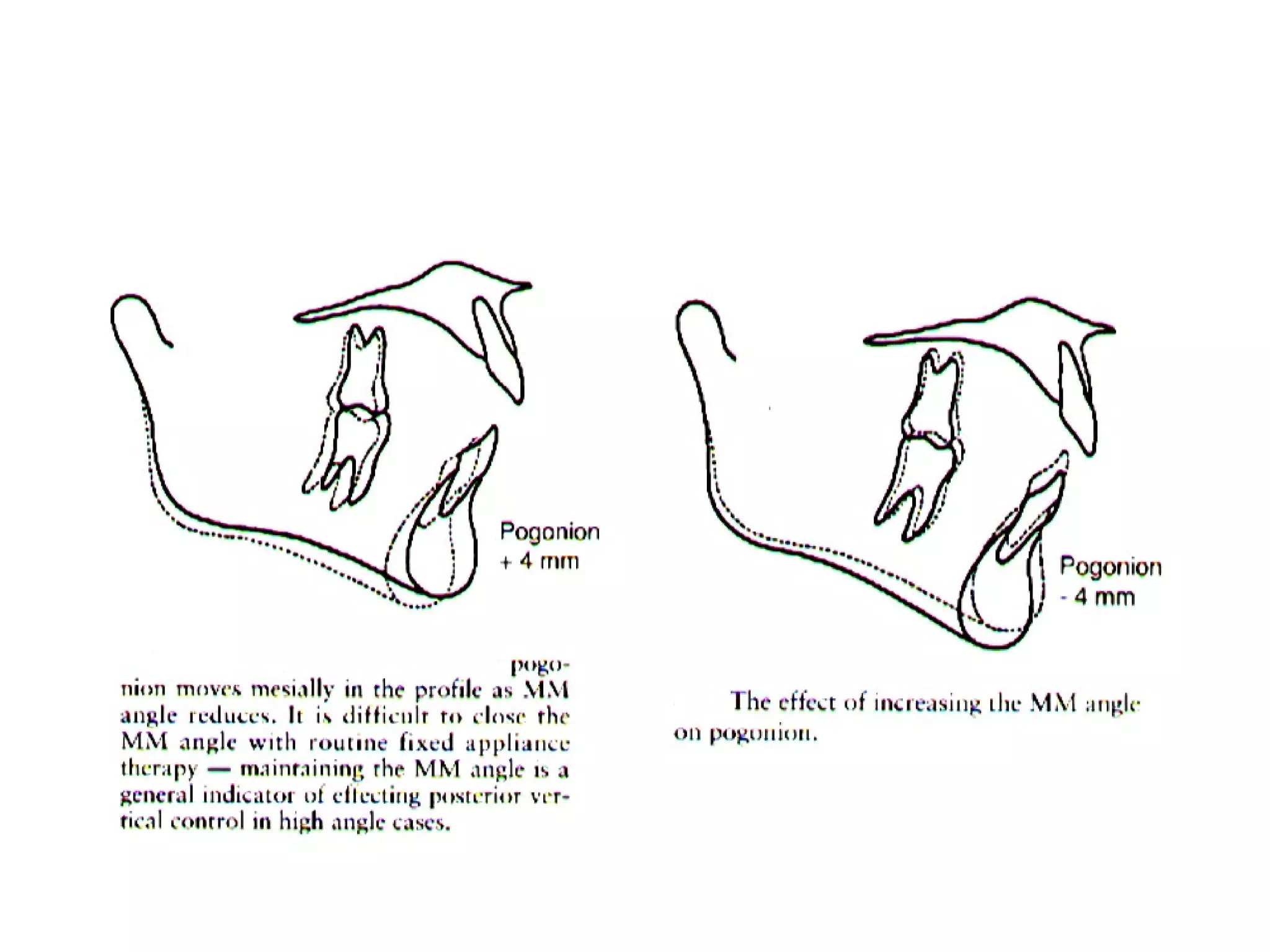 Overjet reduction(2) | PPT