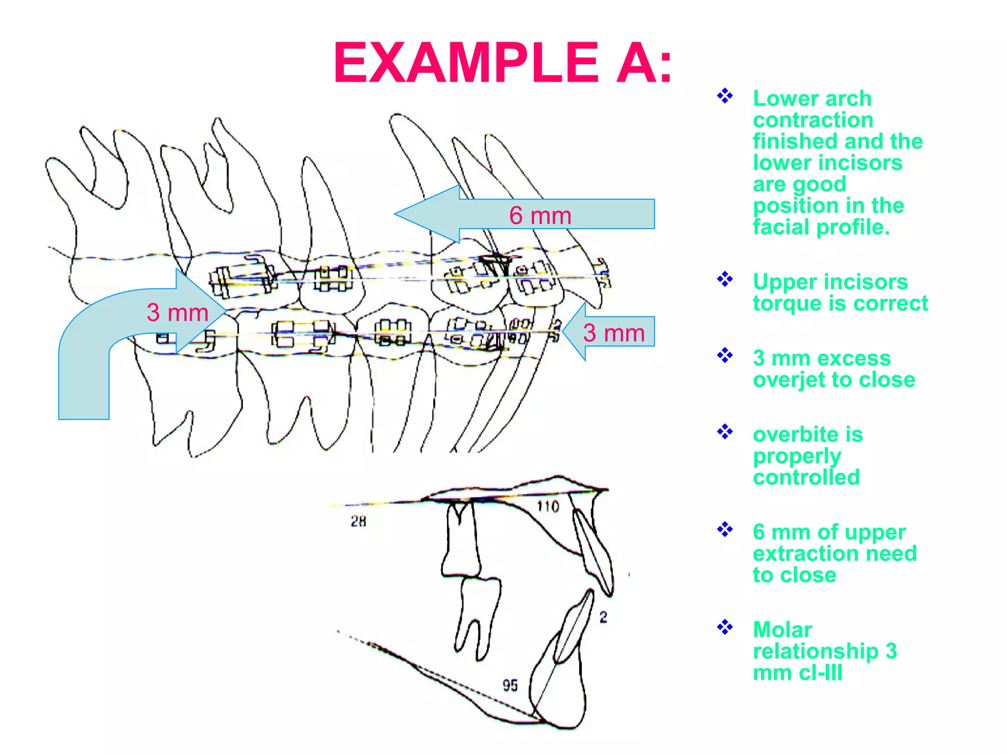 Overjet reduction(2) | PPT