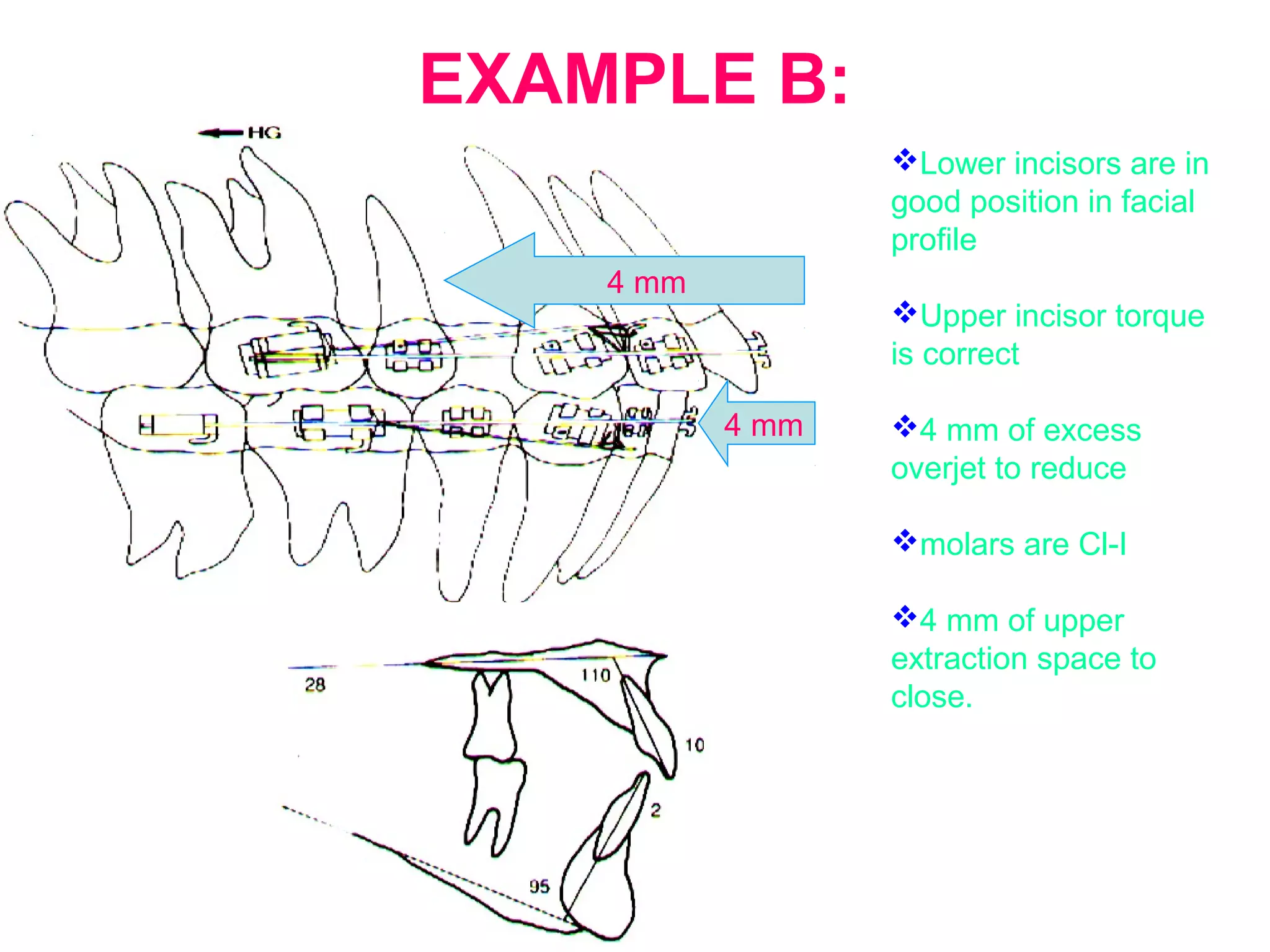 Overjet reduction(2) | PPT