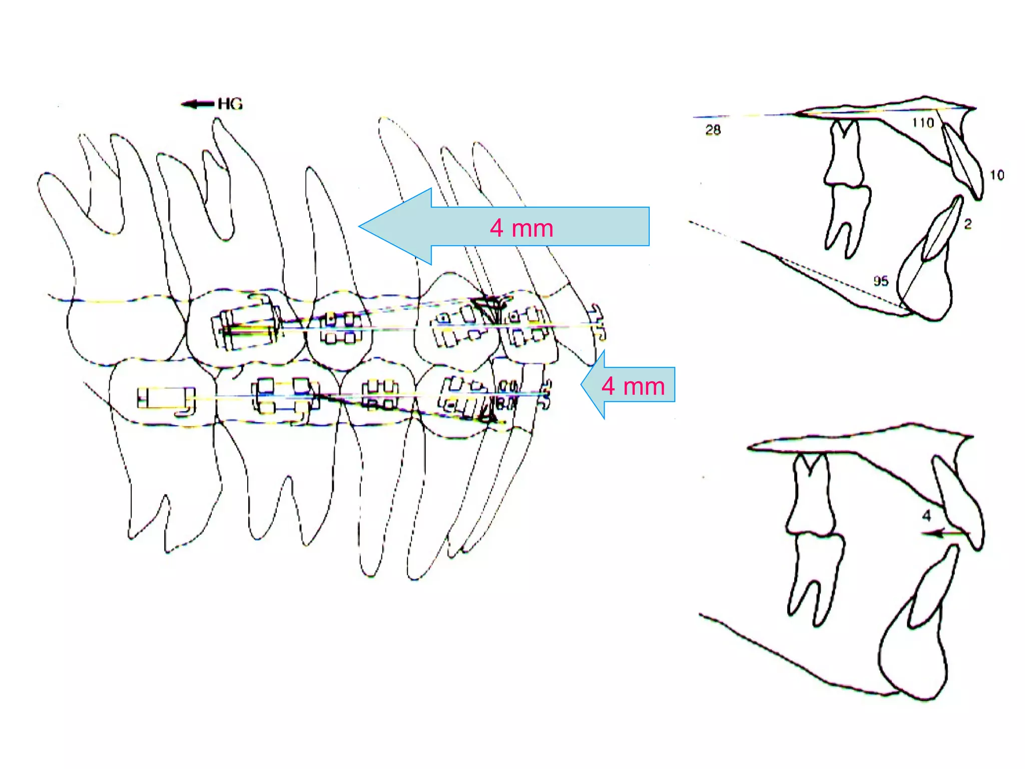Overjet reduction(2) | PPT