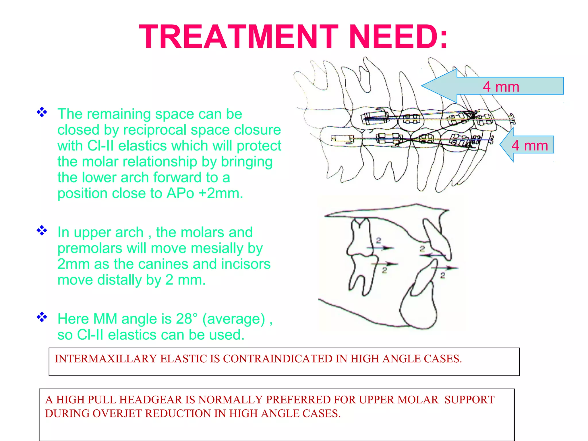 Overjet reduction(2) | PPT