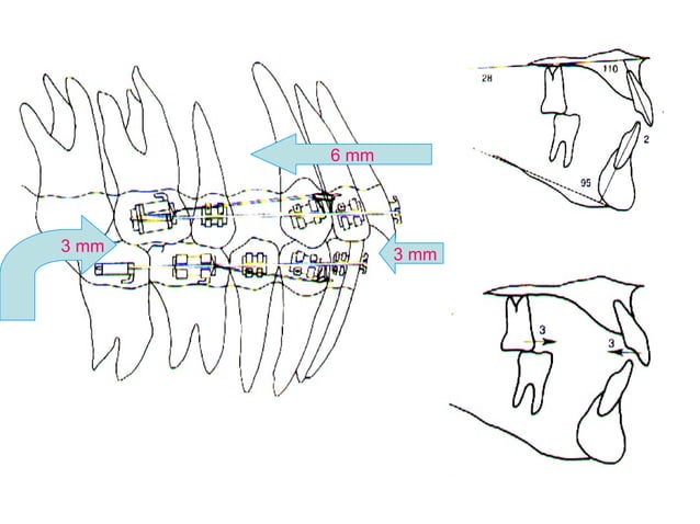 Overjet reduction(2) | PPT