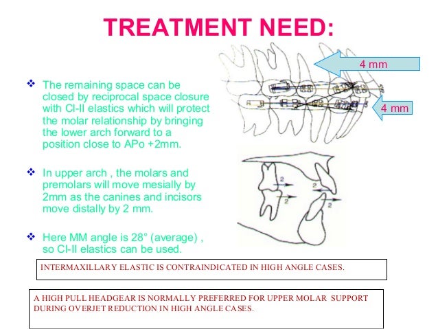 Overjet reduction(2)