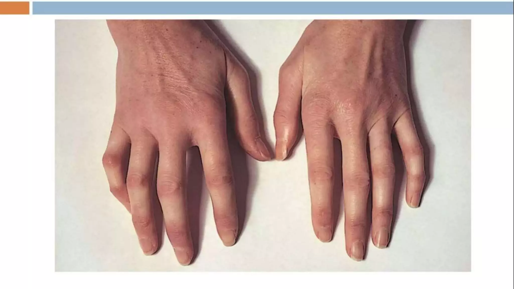 overlap syndrome 1.pptx
