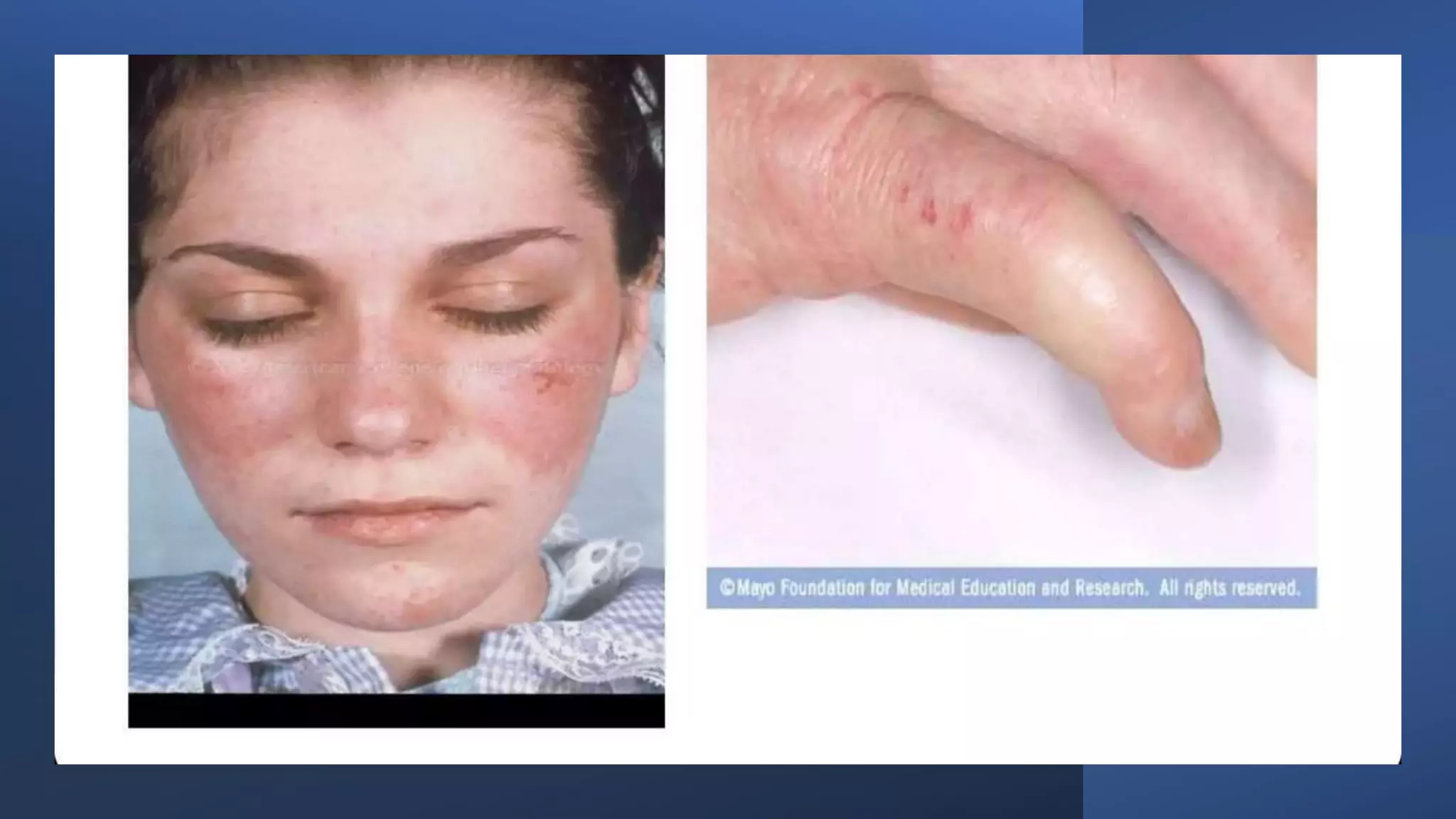 overlap syndrome 1.pptx