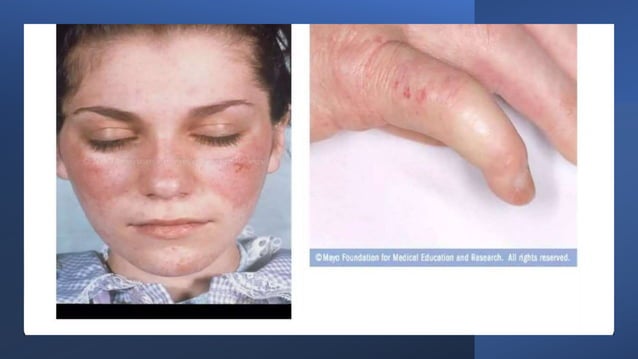 overlap syndrome 1.pptx