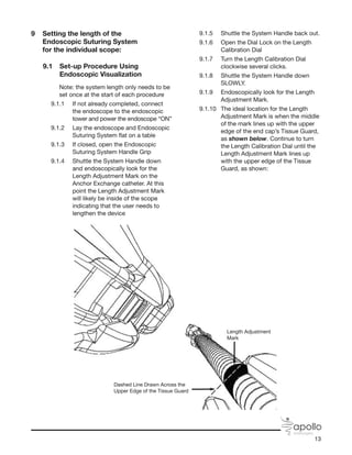 Overstitch - detailed info on this new endoluminal platform | PDF