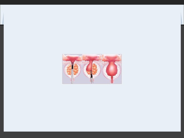 Overview of BPH management, LUTS management | PPT