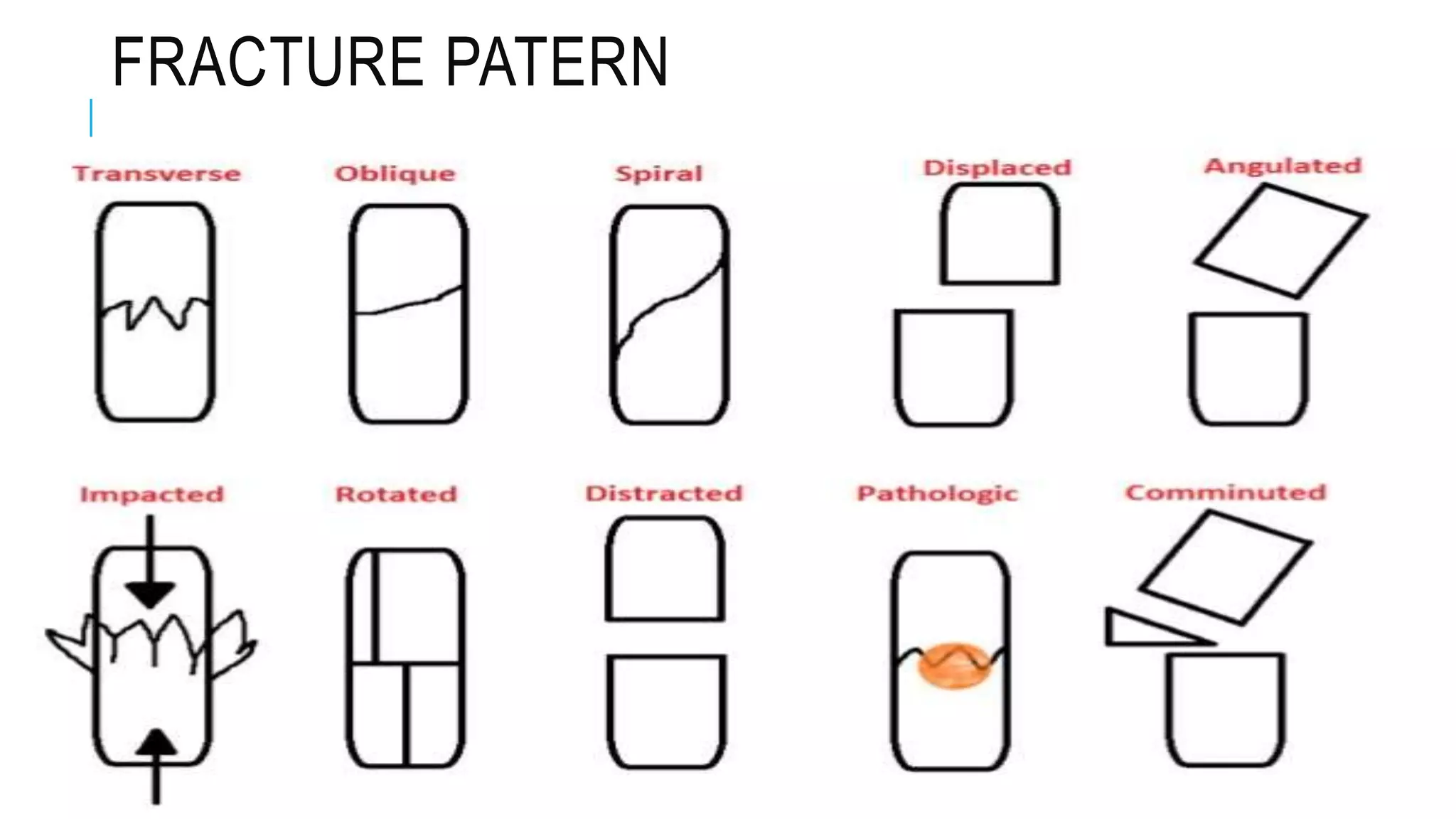 Overview conservative management of long bone fracture in adult | PPTX