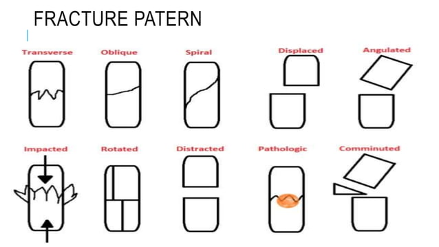 Overview conservative management of long bone fracture in adult | PPT
