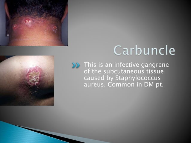 Overview lumps and bumps | PPTX | Skin and Dermatology | Diseases and ...