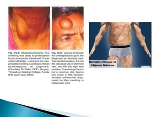 Overview lumps and bumps | PPTX