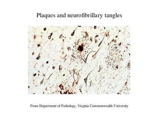 Overview of Alzheimer's disease | PPT