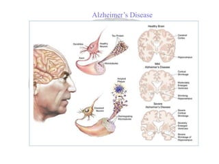 Overview of Alzheimer's disease | PPT